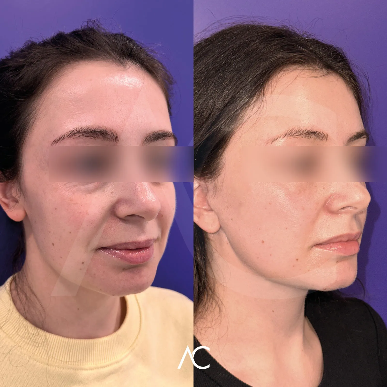 How does the scar look after a facelift? - Dr. Artur Carandell